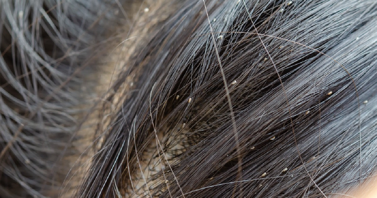 ¿CÓMO SON LOS HUEVOS DE PIOJOS? – My Hair Helpers Natural Head Lice ...